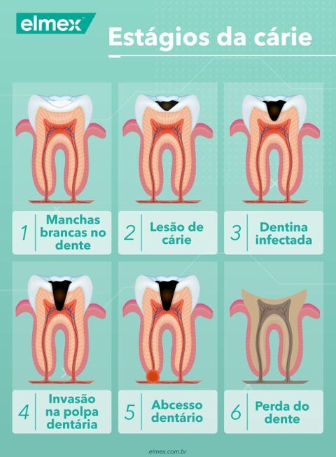 Sintomas de cárie: 5 principais sinais e o que fazer